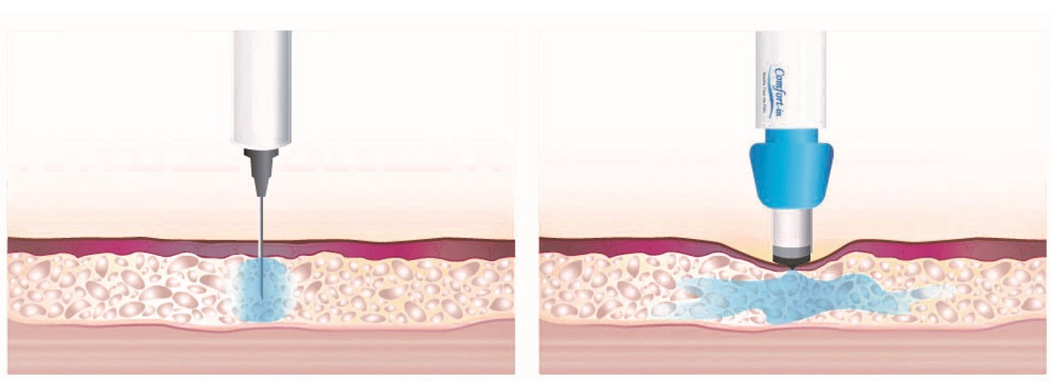 Comfort-in : Le stylo injecteur sans aiguilles, le nouvel outil d ...